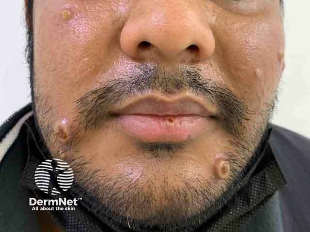 Monkeypox: Symptoms, Transmission, and Prevention - SwitSalone